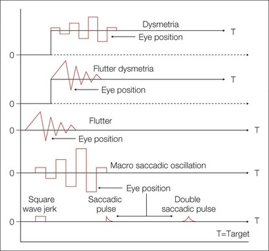 小脳性の眼球運動障害 (矩形波眼球運動 眼ジスメトリア 眼球粗動 オプソクロヌス Bruns眼振):再訪 | 自由が丘 清澤眼科