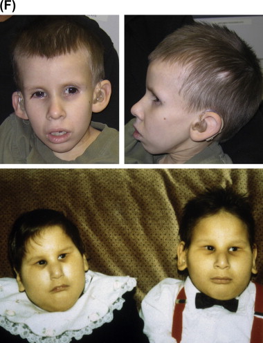 Hallerman-Streiff症候群の眼症状：論文紹介 | 自由が丘 清澤眼科