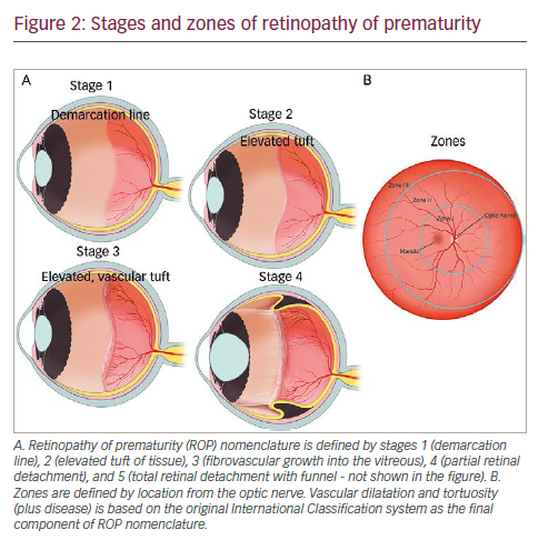 未熟児網膜症とは： | 自由が丘 清澤眼科