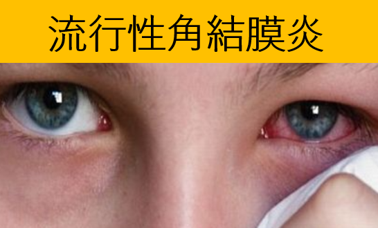 流行性角結膜炎（EKC, epidemic keratoconjunctivitis）とは | 自由が丘 清澤眼科