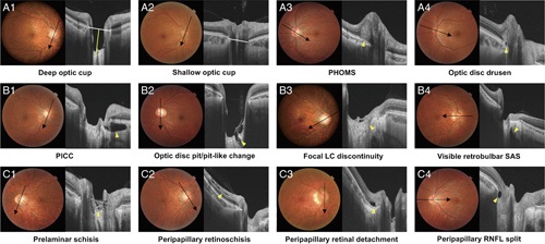 非病的強度近視における視神経乳頭の異常と視野との関係:新論文です | 自由が丘 清澤眼科