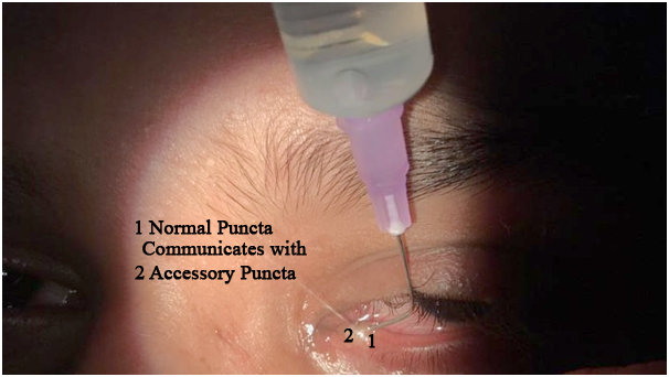 副涙小点をご存じですか？ | 自由が丘 清澤眼科